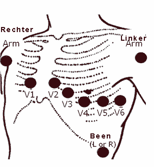 Beoordeling van ECG volgens dit schema (zie extra uitleg en ...